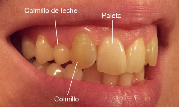 Blanqueamiento dental - Treinta y...